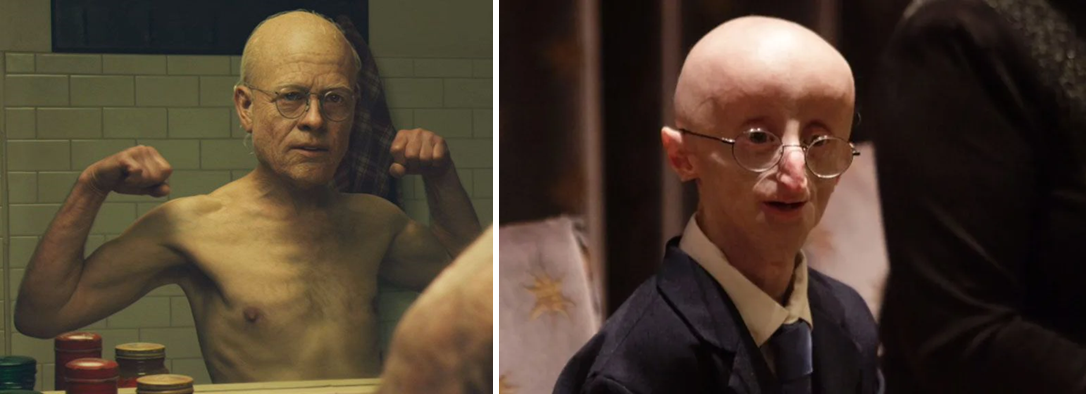 Progeria: El curioso caso de Benjamin Button. – ChemEvol